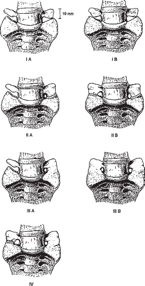 [pdf] Sacral Dysmorphism And Lumbosacral Transitional Vertebrae Lstv Review Semantic Scholar