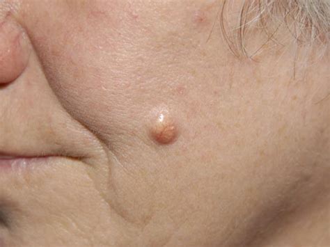 Epidermoid Cysts Face Cysts Types And Treatment Venice Fl