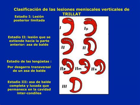 Ppt Patología De Los Meniscos Powerpoint Presentation Free Download