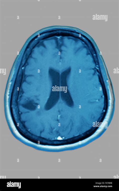 Cerebral Atrophy Mri Stock Photo Alamy