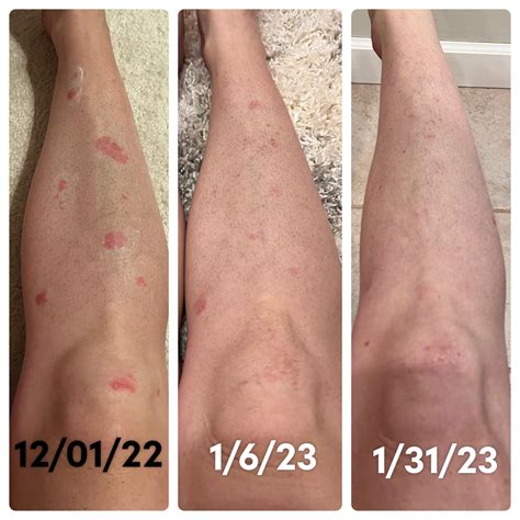 Psoriasis Vtama Review I Stopped Using Vtama About A Week Ago Due To Folliculitis Which Is The