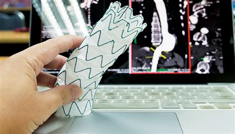 Endovascular Coding In 2018 Aapc Knowledge Center