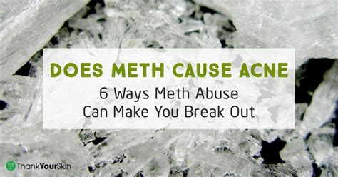 Beware Of This Acne Trigger Does Meth Cause Acne