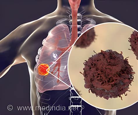 Brca1 Gene Mutation Puts You At Risk Of Developing Aggressive Cancer