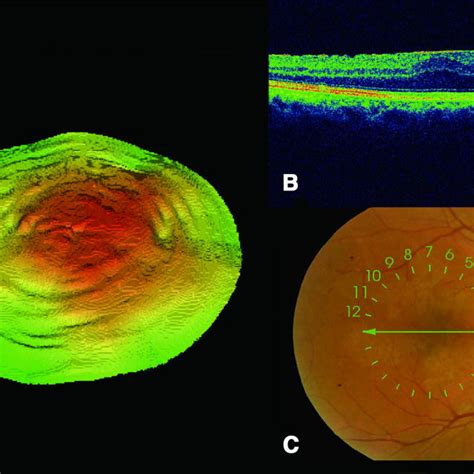 A Representative 3d Oct Image Of Erm Generated B Oct Image Of Erm And Download Scientific