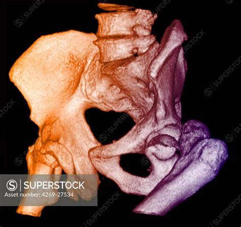 Dislocation Of The Hip 3d Computed Tomographic Ct Reconstruction Scan Of The Pelvis Showing A