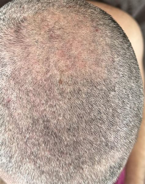 Dry Scalp Or Seb Derm R Dermatologyquestions