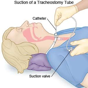 When And How To Do Tracheostomy Suctioning New Health Advisor