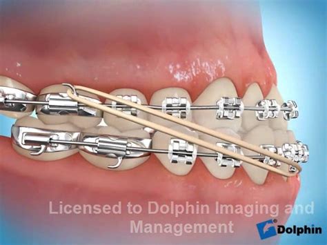 Doctors Videos Dentistry Class Iii Elasticwear Hq