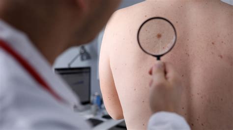 Cancerous Moles What Do They Look Like