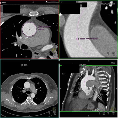 Pheochromocytoma Incidentally Detected On An Aortic Root Evaluation