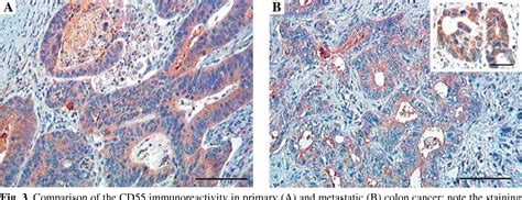 Figure 3 From Comparison Of The Expression Of Complement Regulatory