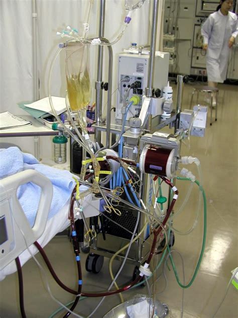 A Discussion From Japan [ 9 ] An Adult Ecmo Circuit