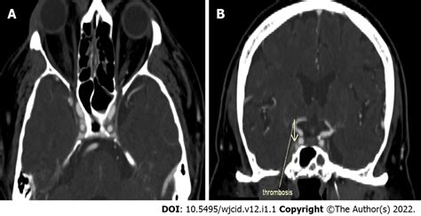 Computed Tomography With Contrast Enhancement A Axial Slice Of