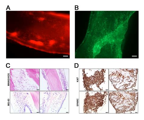 Three Dimensional Bone Extracellular Matrix Model For Osteosarcoma