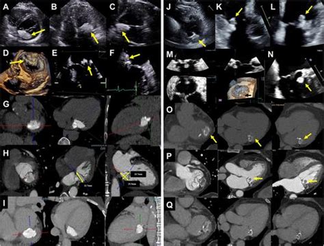 Imaging Of Caseous Mitral Annulus Calcification Dr Sagit Ben Zekry