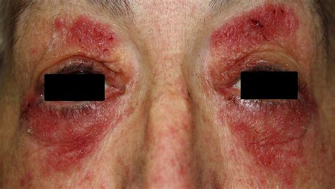 Blefaroconjuntivitis Secundaria Al Tratamiento Con Cetuximab Piel
