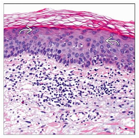 Large Cell Acanthoma Basicmedical Key