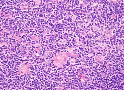 Lymphocyte Rich Hodgkin Lymphoma Light Micrograph Stock Image C051 0558 Science Photo Library