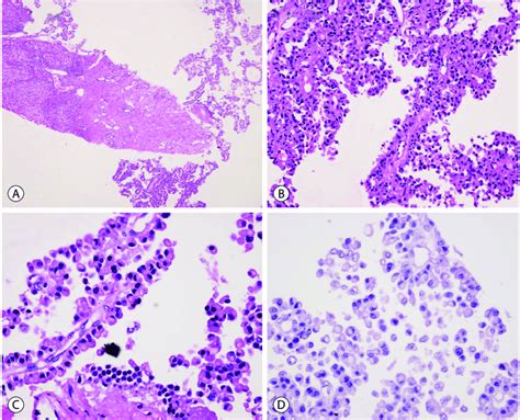 Microscopic Features Of The Tumor Low Power Magnification Demonstrates
