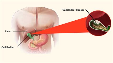 Gallbladder Cancer Expert Reveals 7 Facts You Must Know Of Onlymyhealth