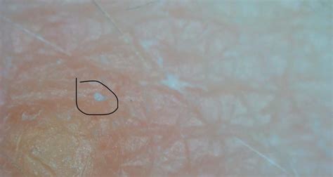 This Is On My Arm I Think Im Rid Of Scabies Please Someone Reply Are