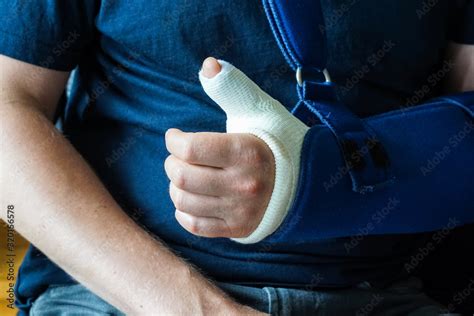 Foto De Man With Plaster Cast On Broken Thumbbroken Wrist Broken Hand