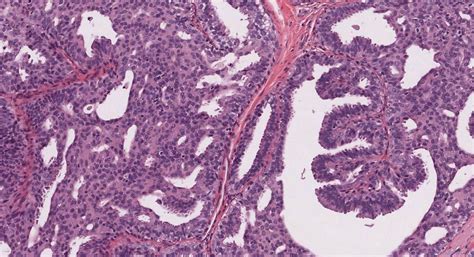 Intraductal Papilloma Atlas Of Pathology