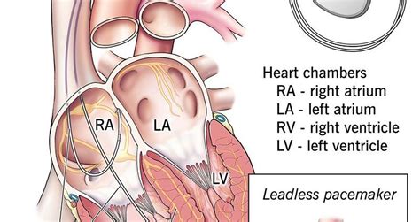 Pacemaker Indicaties Procedure Complicaties Hoe Werkt Een