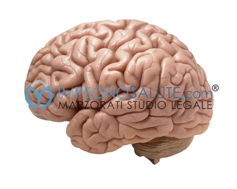 Idrocefalo Errore Malasanità E Risarcimento Danni