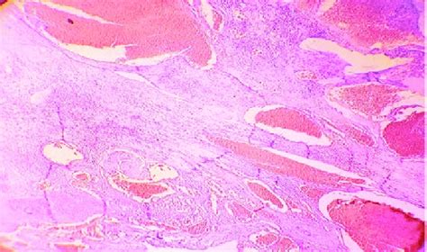 Histopathology Showing Multiple Vascular Spaces Filled With Blood