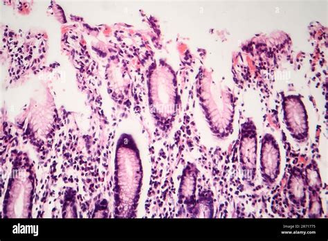 Histopathology Of Chronic Atrophic Gastritis Light Micrograph Photo