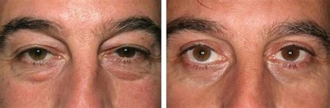 Everything You Need To Know About Blepharoplasty Recovery