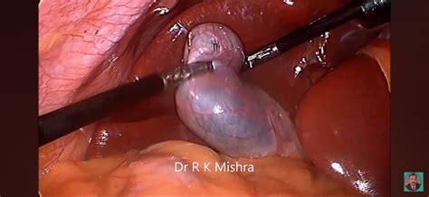 Laproscopic Surgery Object Detection Model By Cad