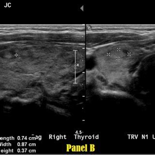 Multiple Nodules Shown By X Download Scientific Diagram
