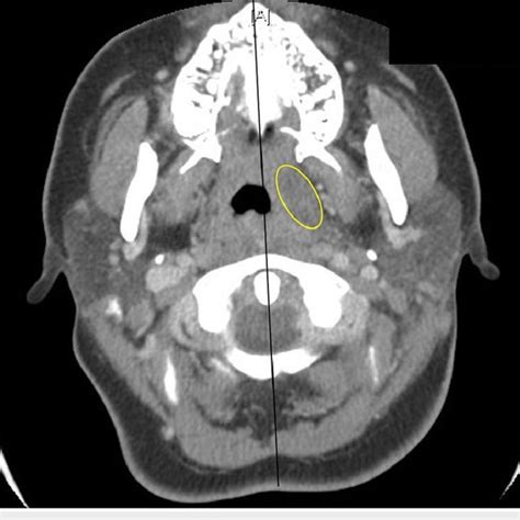 Axial View Computed Tomography Image Demonstrating Midline Shift And