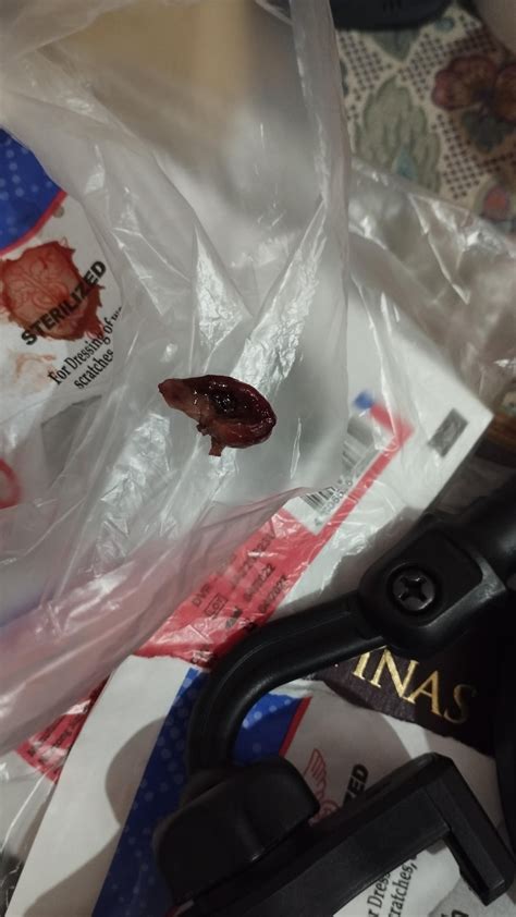 Terrified Of Dry Socket 1 Day After Wisdom Tooth Extraction Huge Blood