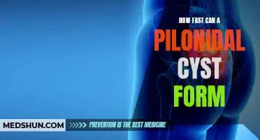The Timeline Of Pilonidal Cyst Formation How Quickly Does It Occur