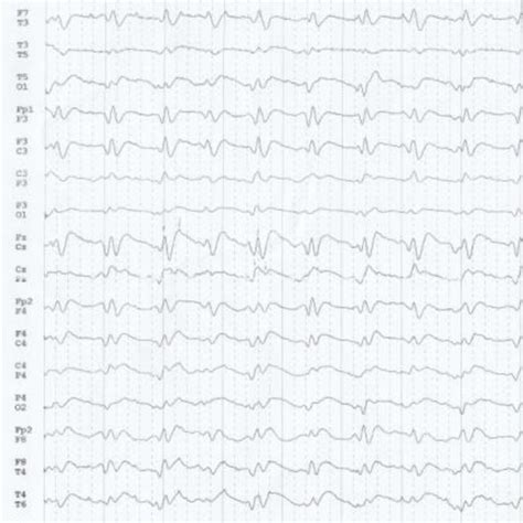 New Eeg Showed Periodic Sharp Wave Complexes Pswc Suggesting Cjd