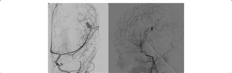 Cerebral Arteriography Of Case 1 Distal Aneurysm Of The Left Mca 4 ×