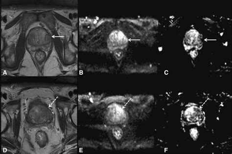 True Positive Pirads 4 And False Positive Pirads 5 Nodules In