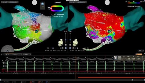 [video] Cody Schoenfuss Ceps Mbid On Linkedin Epeeps Optrell