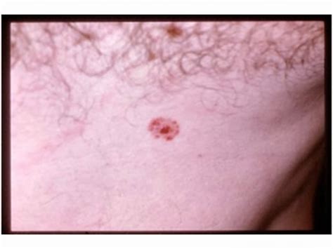 Dermpath Made Simple Neoplastic T And B Cell Lymphomas