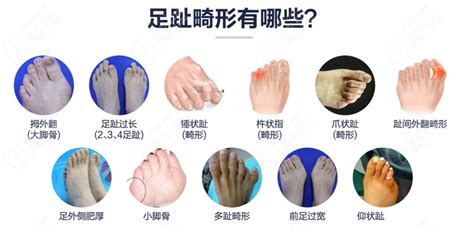 苏敬达和谁做大脚骨手术好价格和技术水平对比看哪个更靠谱 美佳社区