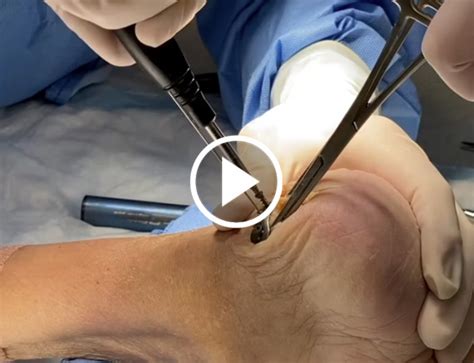 Youngswick Osteotomy Procedure With The Accu Cut Osteotomy Guide System