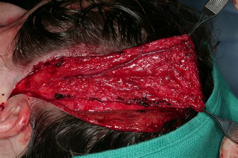 Temporoparietal Fascia Flap Iowa Head And Neck Protocols Carver