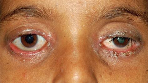 Staphylococcal Blepharitis Overview Symptoms Treatment And More