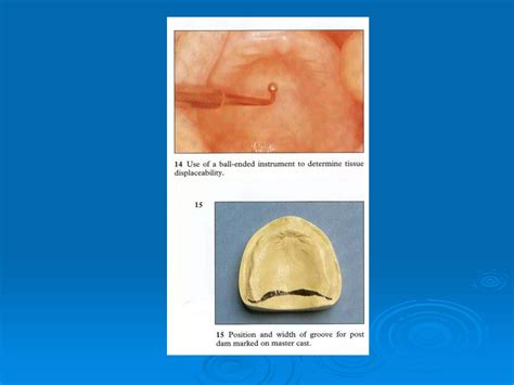 Maxillary Anatomical Landmarks Ppt