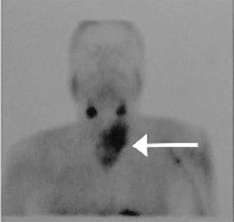 99‐m Tc‐mibi Parathyroid Scintigraphy Gpa Showed By Arrow Download