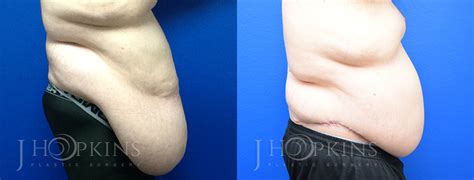 Hyperpigmentation On Panniculus